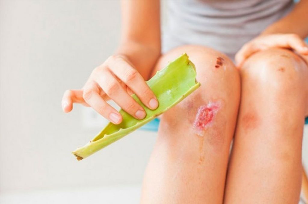 Sábila: poder curativo en las heridas | Aloe Vera Saludable